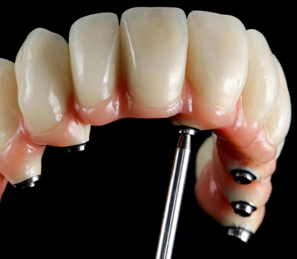 Feste Zähne an einem Tag - Zahnarzt Nürnberg Dr. Enssle